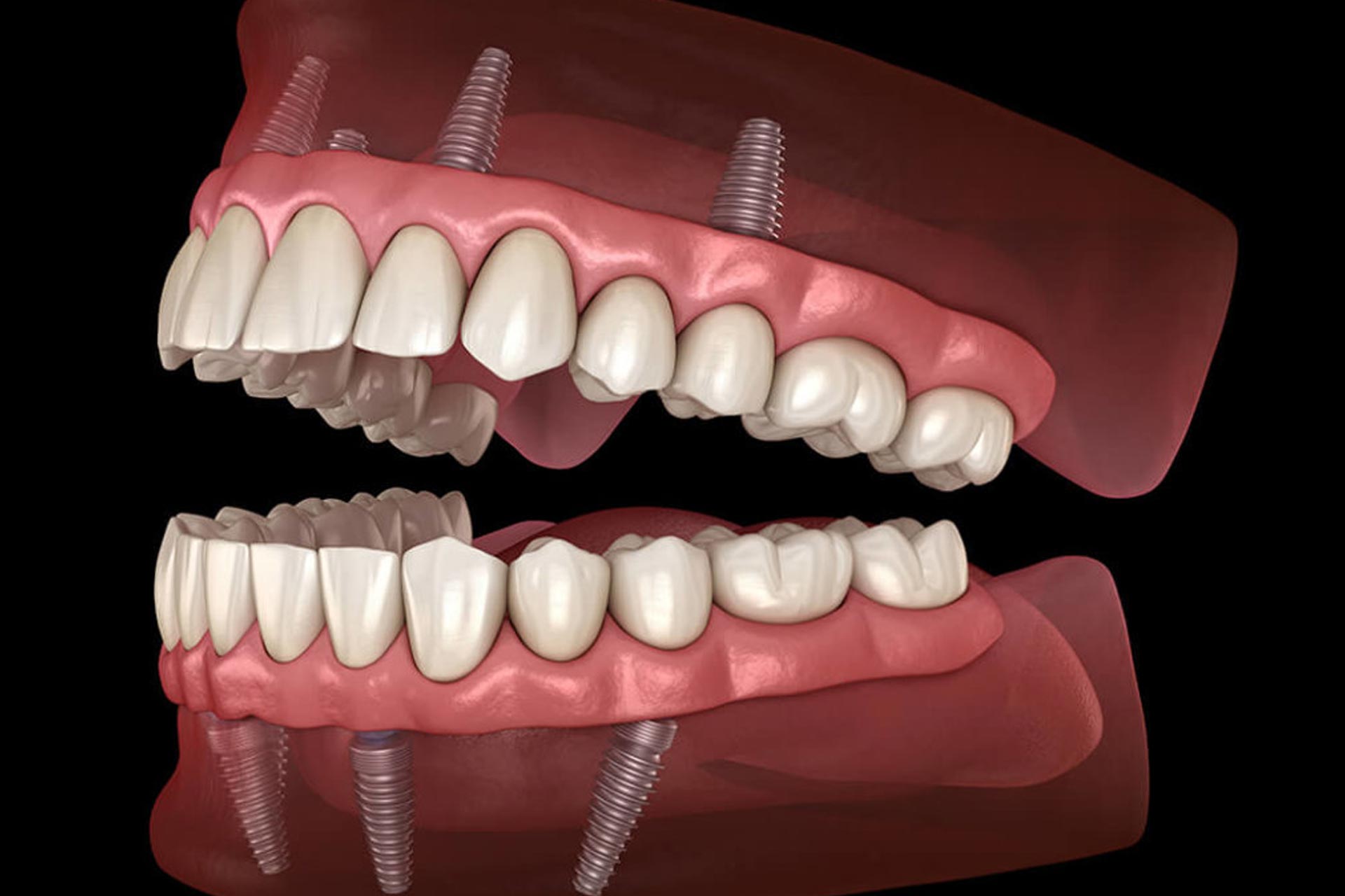 All-On-X Implants – Wisdom Castle